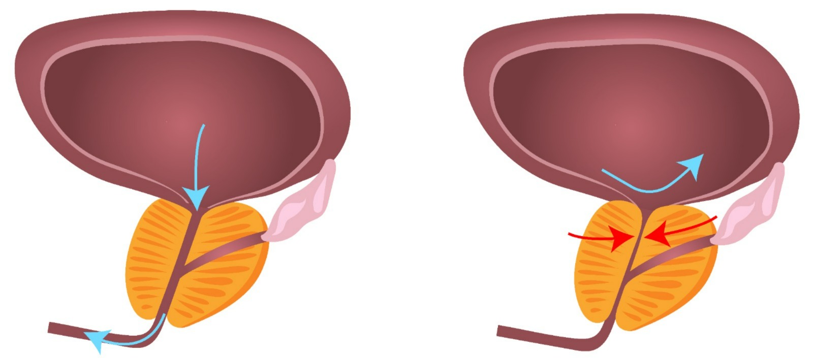 Câncer de próstata X Hiperplasia prostática benigna - urologia ...